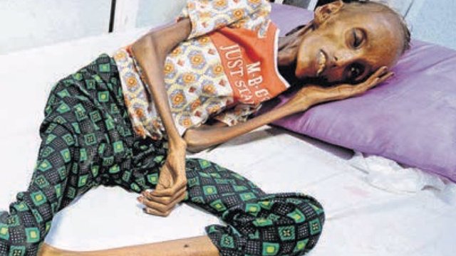 Distressing Images Of Starving Yemen Kids Stun World - LBC